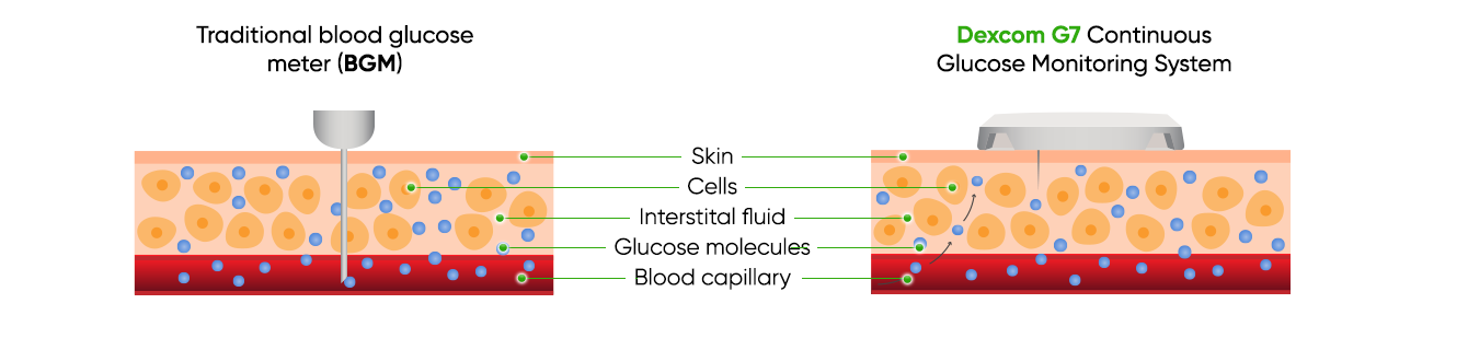 What Is CGM for Diabetes? | Dexcom